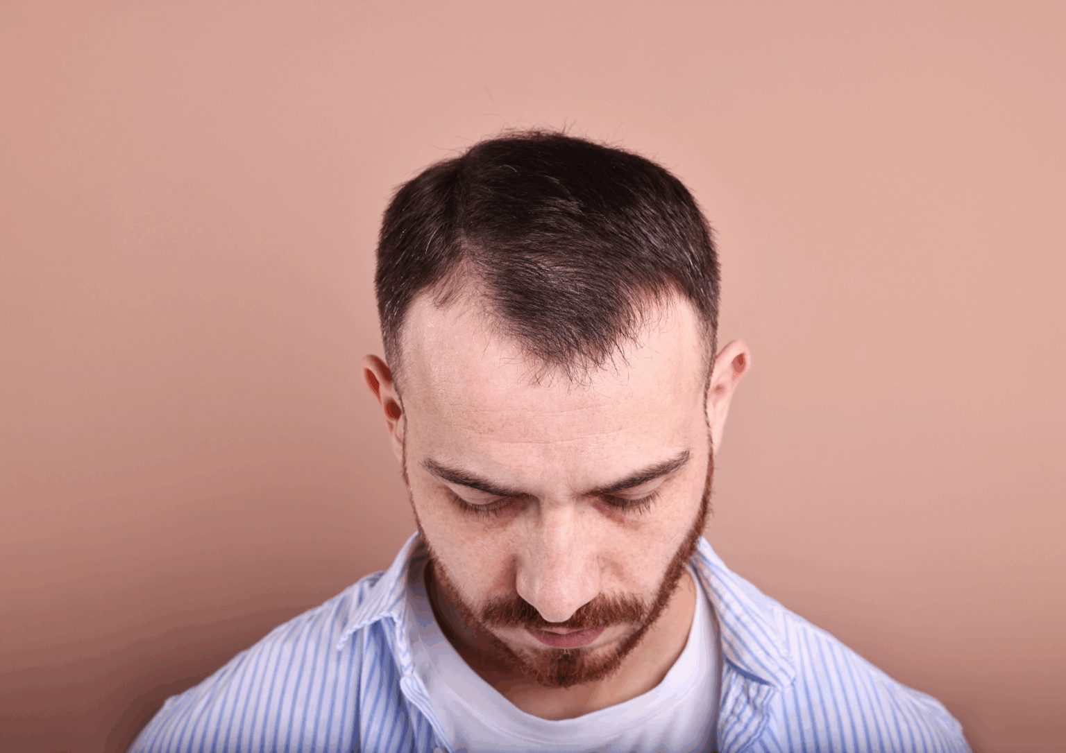 ジヒドロテストステロン（DHT）を減らす3つの方法｜原因・特徴・運動・サプリ・排出まで解説 | ベアAGAクリニック｜新宿で薄毛治療なら当クリニック